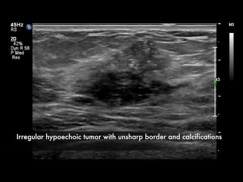 Breast ultrasound - cancer