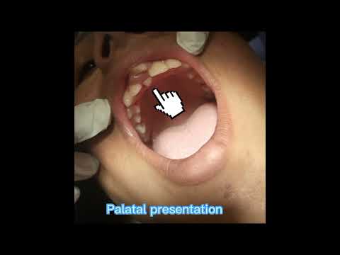 Extraction of supernumerary tooth