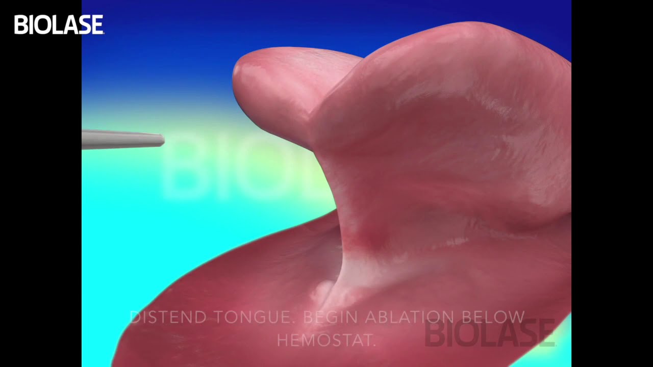 Lingual Frenectomy Biolase | Streamhealth Dental