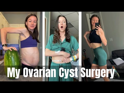 Ovarian Cyst Surgery Changed My Life (27 pounds removed)