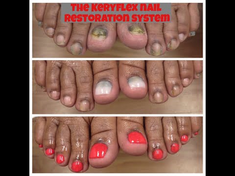 The Keryflex Nail restoration solution for fungal nails.