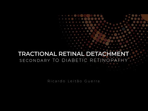 Tractional retinal detachment due to diabetic retinopathy