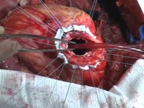 Heartmate II LVAD Implantation. Arie Blitz, MD