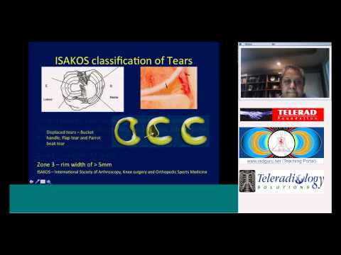 Radiology talks on Lateral Meniscus by Dr. Anna Chacko