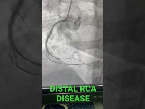 DISTAL RCA DISEASE #shorts