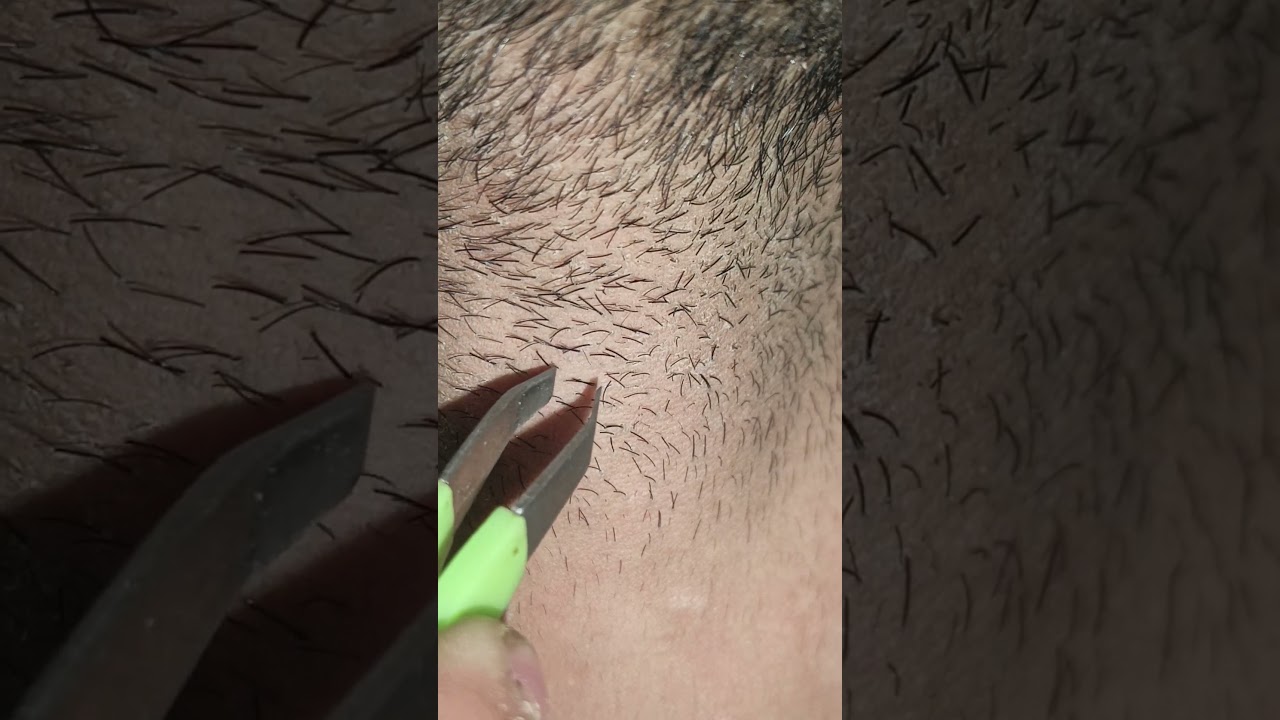 Removed ingrown hair #barber #barbershop #haircolour