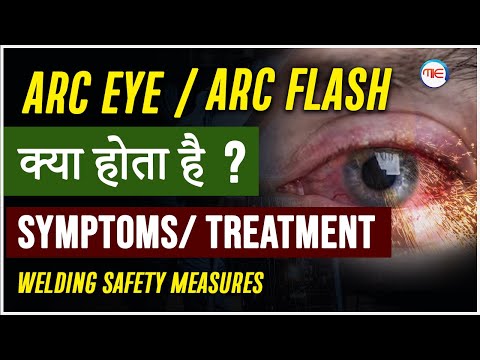 Arc Eye क्या होता है? Arc Flash क्या होता है ? Arc Flash Explained | Welding Flash | Welding Safety