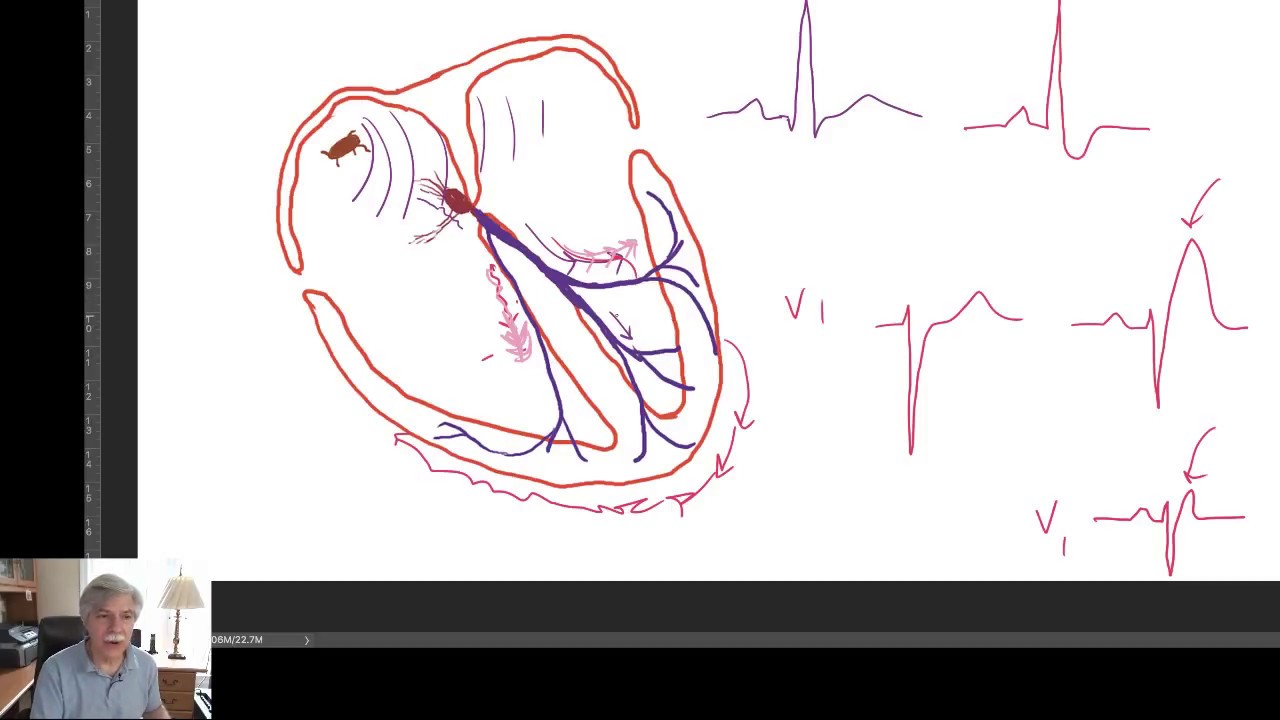 Trifascicular Block Explained Simply – WHY, WHEN, HOW?