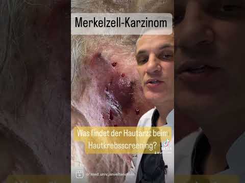 Hautkrebs : Merkelzell-Karzinom!