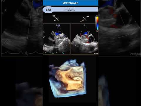 Watchman Implant