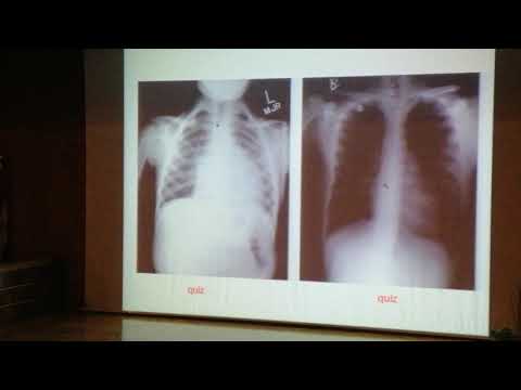 Chest X ray interpretation in Pediatrics feb 2020
