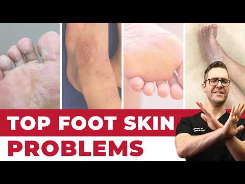 Skin Conditions on Feet - 10 Best Facts