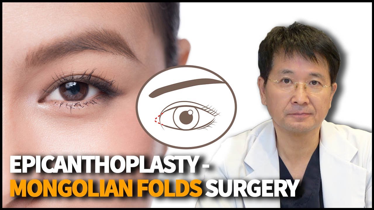 Epicanthoplasty - Eye Surgery that modifies the Epicanthal Folds