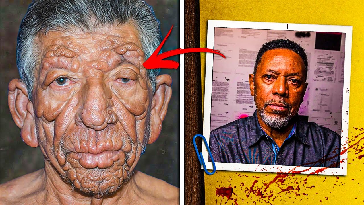 Why You Wouldn't Survive Leprosy
