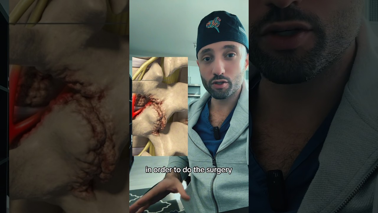 Surgery for sciatica and nerve compression/spinal stenosis. #sciatica #lowbackpain #backpain