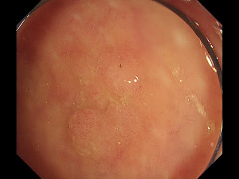 Rectal ESD -- poorly defined LSTNG