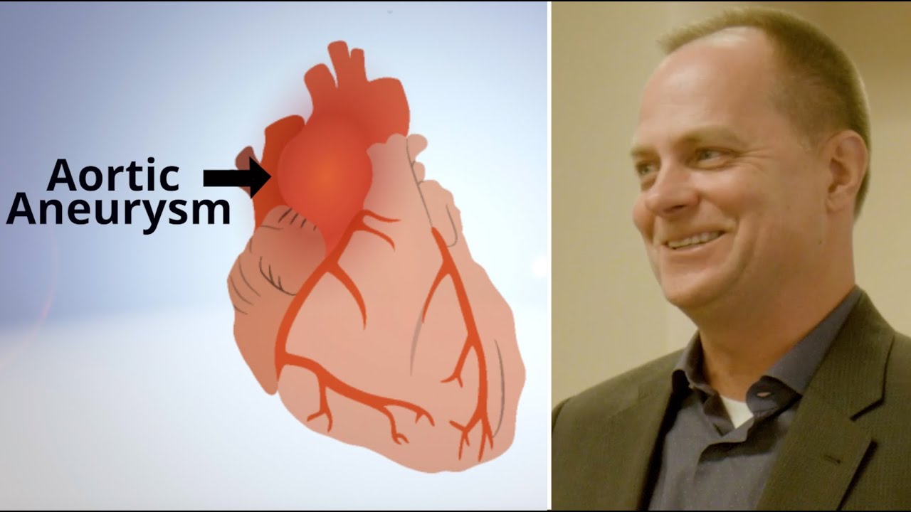 Valve Sparing Aortic Root Replacement (Tom's Patient Success Story)