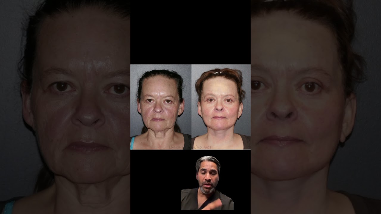 Deep plane facelift - 1 month results! Denver, Colorado