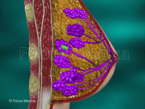 In situ carcinoma - Animated Atlas of Breast and Gastric Cancer