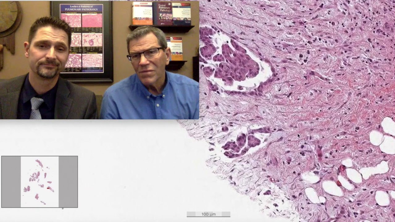 Pattern 5 – Nodules, Malignant Mesothelioma (Top 25 Pearls Series, Topic 5, Pearl 1)