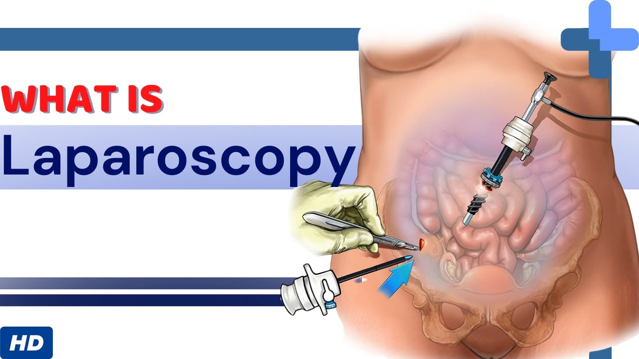 What Is Laparoscopy?