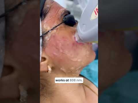 Does Laser Treatment Cause Cancer? Dermatologist Dr. Amit Kerure Explains