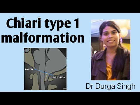 Chiari type 1 malformation