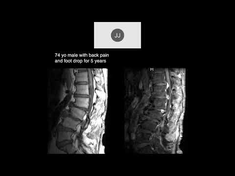 MRI of Lumbar Degenerative Disease, Part 1 | 2023