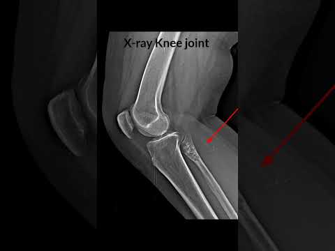 X-Ray Knee Joint -Enchondroma - fibula #xray #shorts