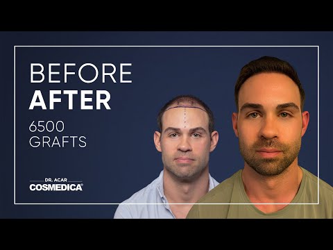 Hair Transplant in Turkey | Results | Dr. Acar | Cosmedica Clinic