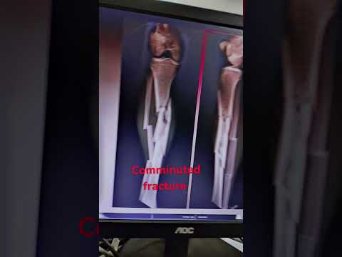 Leg fracture // comminuted fracture // tibia and fibula fracture