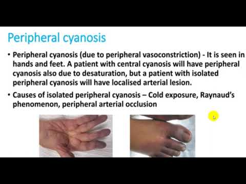 APPROACH TO CYANOSIS 4TH YR