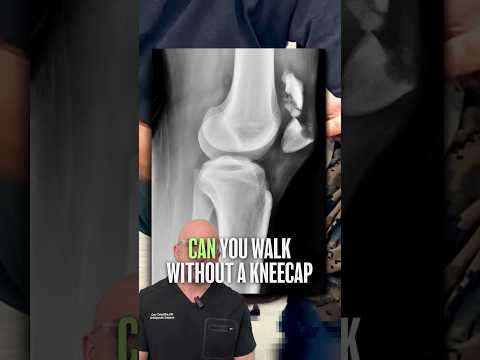 Why Doctors Say Keep Your Kneecap!