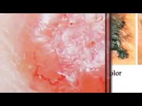 How to Diagnose The Early Signs And Symptoms of Skin Cancer | Healthy ...