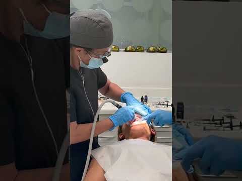 MICROCARILLAS DENTALES EN UN SOLO DÍA