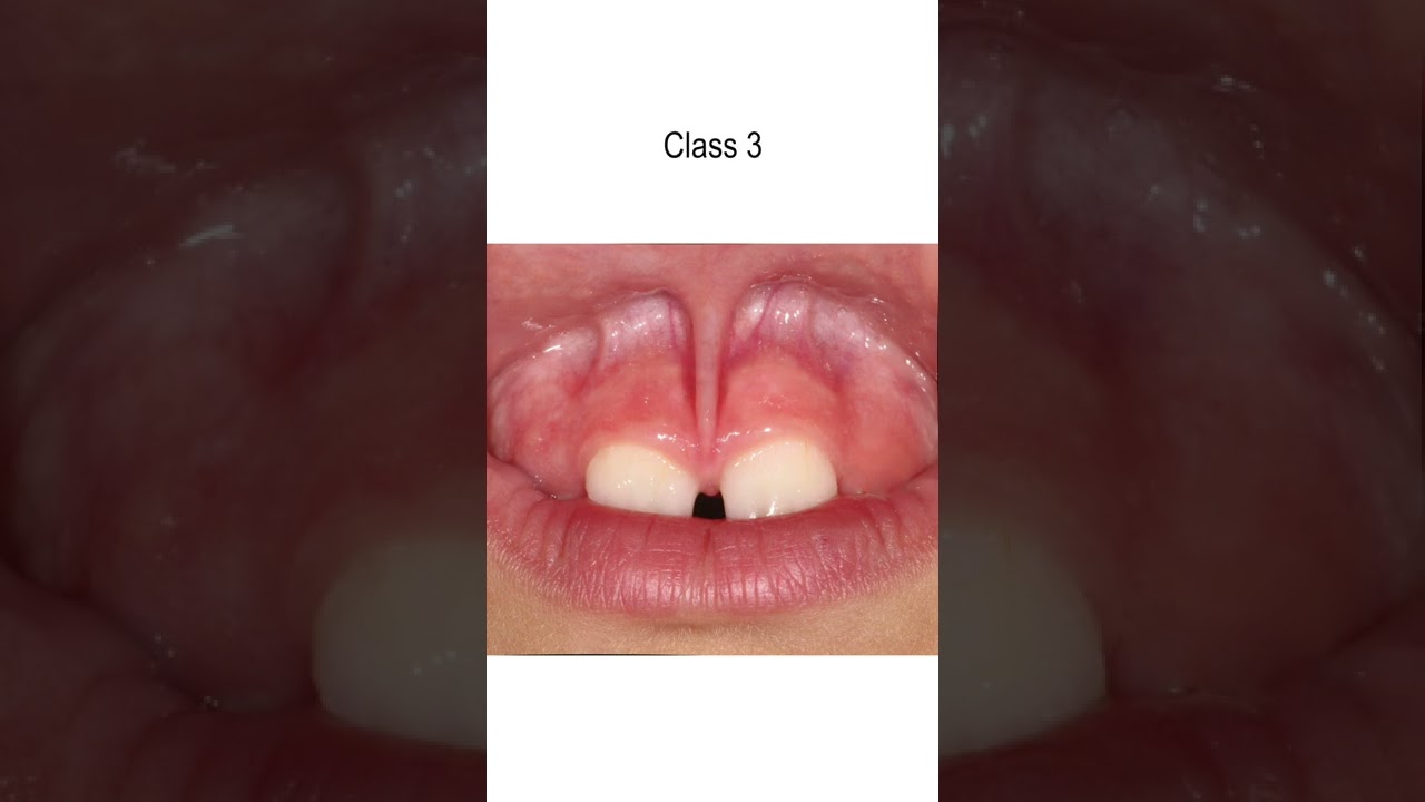 Upper Lip Tie Class 1 - 4 #shorts @fauquierent