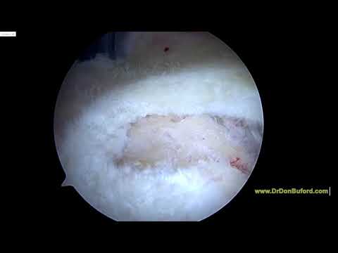 R Shoulder 2cm rotator cuff repair and soft tissue biceps tenodesis 5.21.18 PS