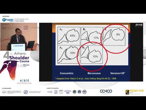 Pre OP imaging and planning for RSA with or without specific software John Costouros