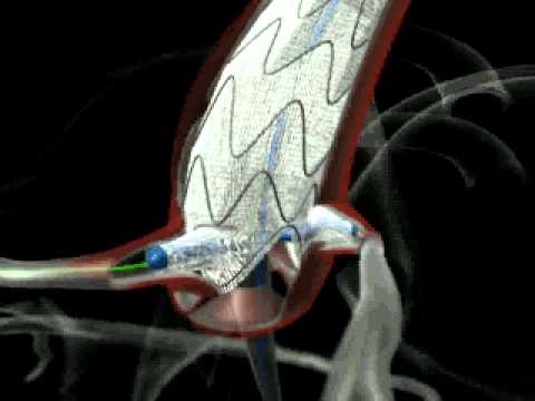 Ascending Thoracic Aorta Stent Graft (ATAG)