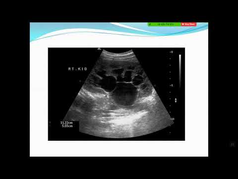 Imaging of the pediatric genitourinary system