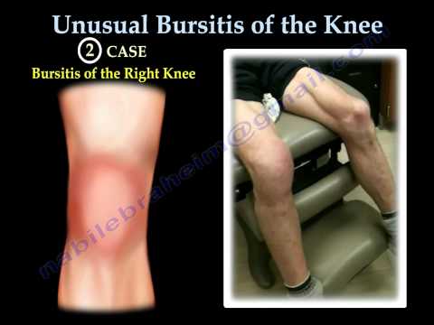 Unusual Bursitis Of The Knee - Everything You Need To Know - Dr. Nabil Ebraheim