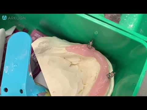 Locator Overdenture