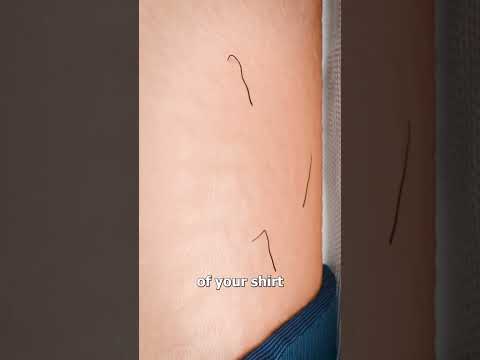 What’s Inside A Pilonidal Cyst? 😨