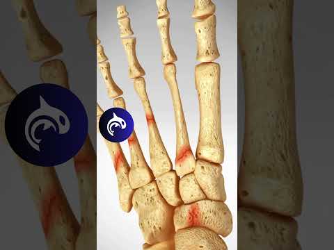 See what a Stress Fracture looks like #feet #foot #anatomy