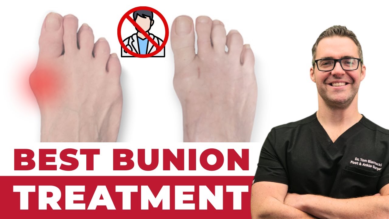 Top Bunion Fixes [Splints Pads Correctors] That Help Fast! NO SURGERY