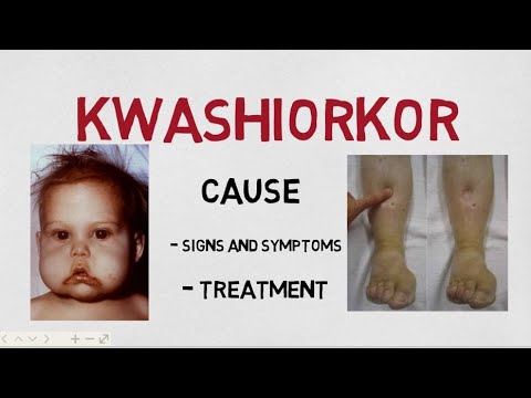 Kwashiorkor in detail ( protein energy malnutrition )