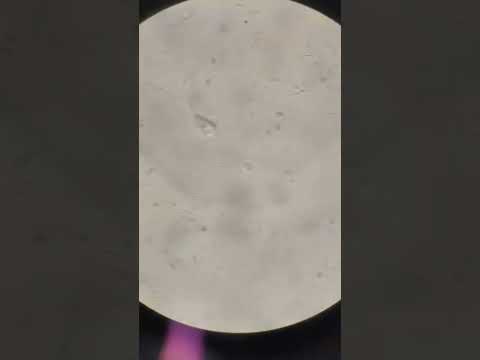 Waxy cast in urine #shorts