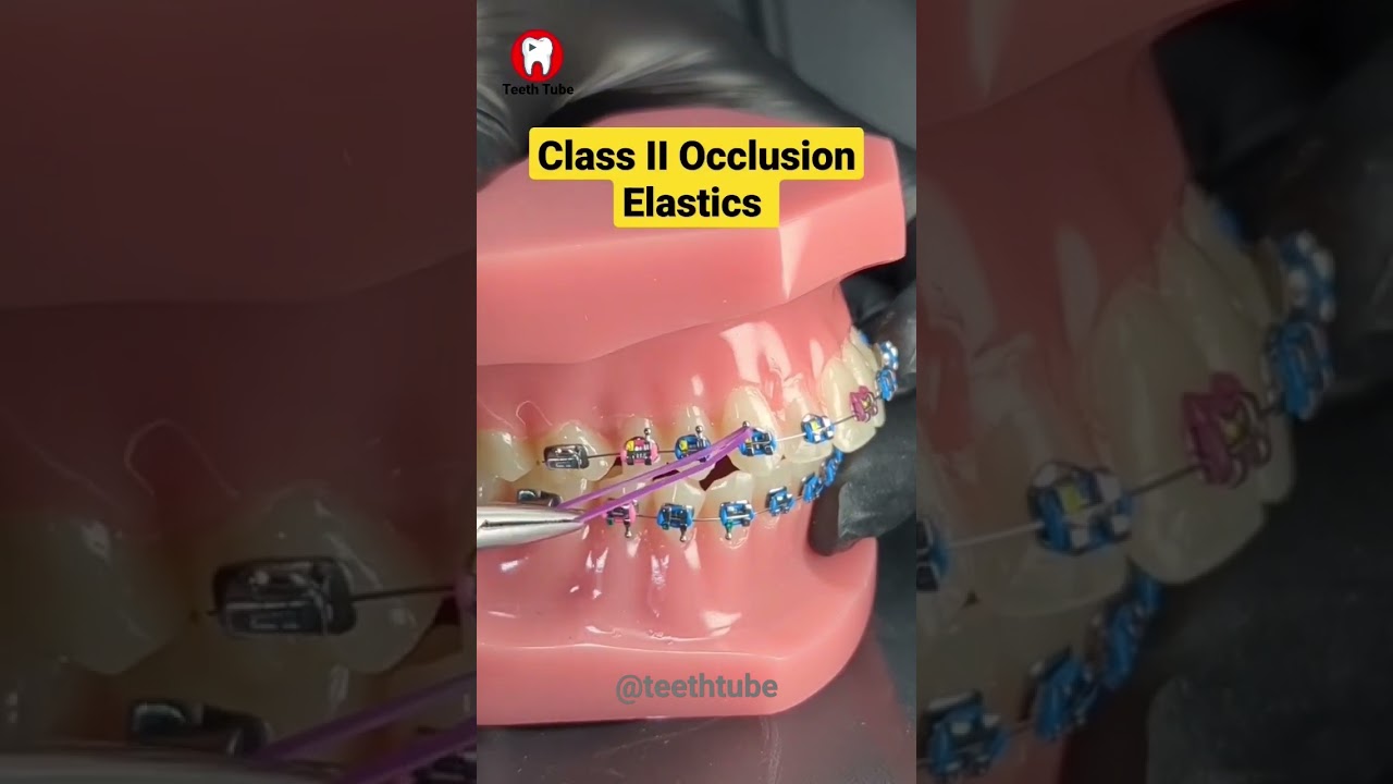 Class II Occlusion Elastics #shortvideo #shorts #elastics