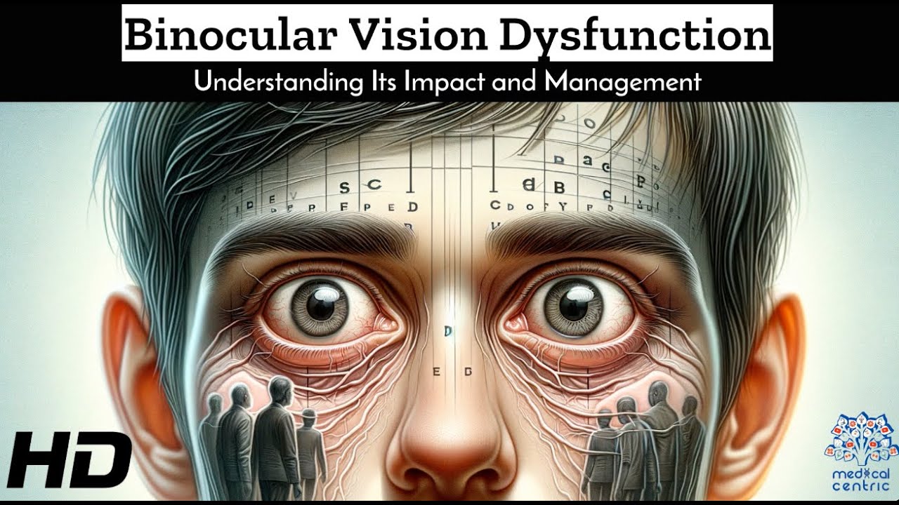 Binocular Vision Dysfunction: From Diagnosis to Management