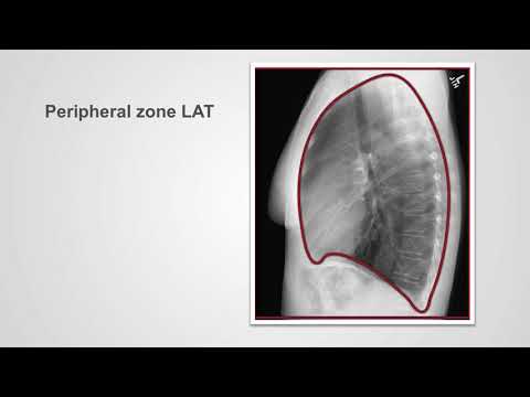 Radiological zones—and an introduction to landmarks